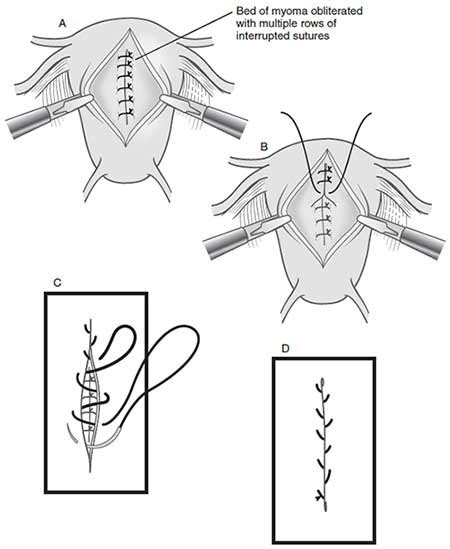 Myomectomy Case File