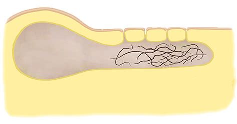 What Is A Pilonidal Cyst And How Does It Develop