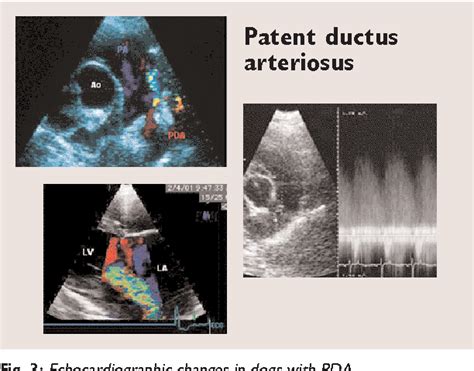 Figure 4 From Aortic Stenosis Types 1 Boxer Semantic Scholar