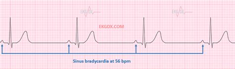 Sinus Bradycardia