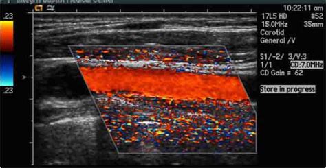 Color Doppler Image Interpretation Flashcards Quizlet