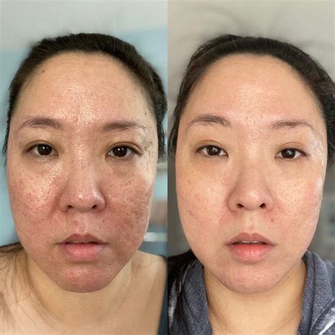Face Before And After Vitamin C Serum Astonishing Transformation Unveiled