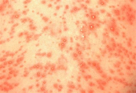 Vesicular Rash A 13 Month Old Presents With Fever Rash And Congestion