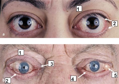 Endocrine Orbitopathy Ento Key