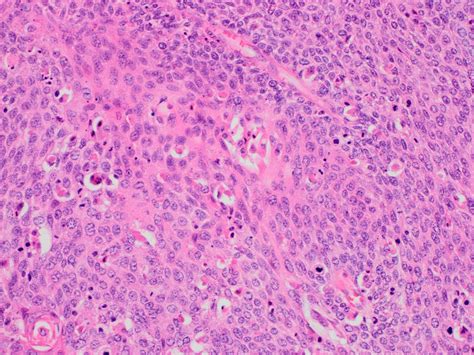 Squamous Cell Carcinoma Bladder Gross