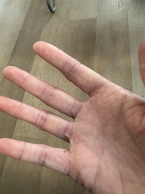 Is This Scleroderma Do Your Hands Look Like This 28 Year Old F R Scleroderma