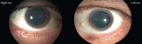 Anterior Segment Diffuse Photography At The End Of Two Years Follow Up