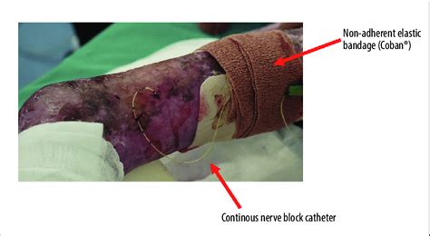 Fixed Continuous Sciatic Nerve Block Catheter Red Arrows Indicate Download Scientific Diagram