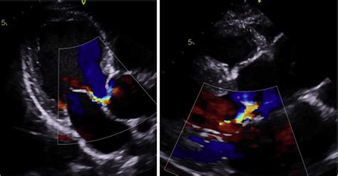 Transthoracic Echocardiogram Download Scientific Diagram