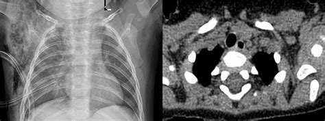 Preoperative Ct And Key Surgical Procedures Of Thoracoscopic