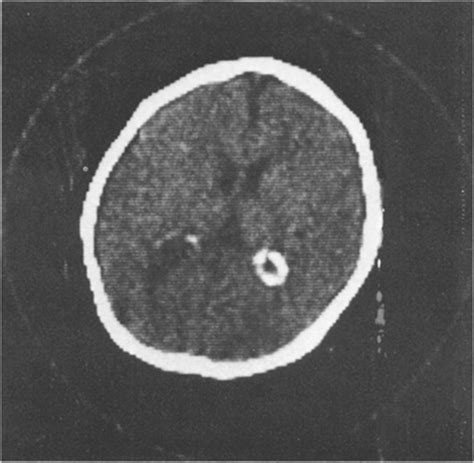 Xanthogranuloma Of The Choroid Plexus Image Xanthogranuloma Of The