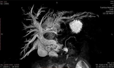 Cholangio Mri Sequence Dilated Intrahepatic And Extrahepatic Bile