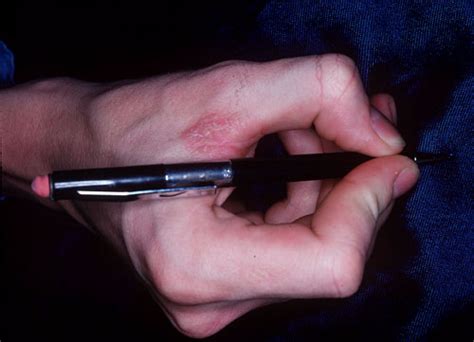 Dermatitis Flashcards Quizlet