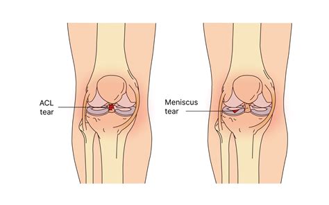 Acl Vs Meniscus Tear Symptoms Diagnosis And Daily Impact