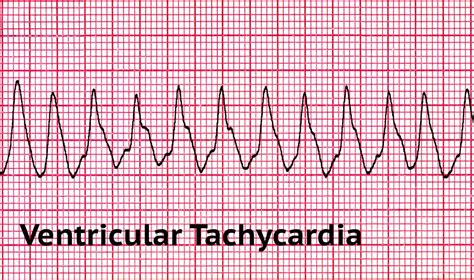 Tachycardia With A Pulse Algorithm Explained ACLS Certification