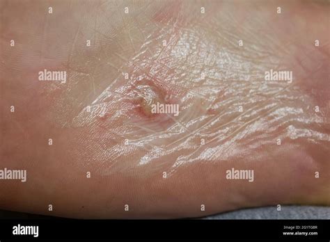 Dermatitis On Top Of Toes At Lachlan Ricardo Blog