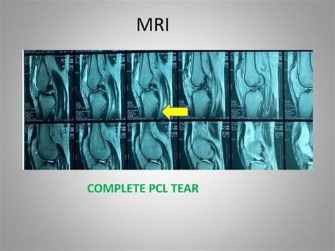 Arthroscopic Pcl Reconstruction Pptx