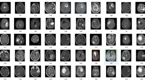 Brain Tumor Detection Using Deep Learning And Vgg 16 Architecture