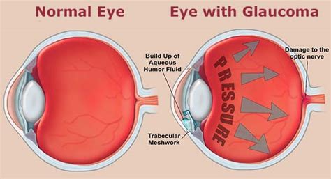 Glaucoma Symptoms Causes And Homeopathic Treatments Welcomecure