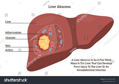 Liver Abscess Human Internal Organ Tissue Stock Vector Royalty Free 2284105345 Shutterstock
