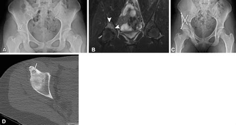 Intra Articular Osteoid Osteomas Imaging Manifestations And Mimics