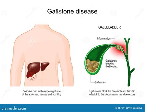 Gallstone Disease Cross Section Of Gallbladder With Gallstones Stock Vector Illustration Of
