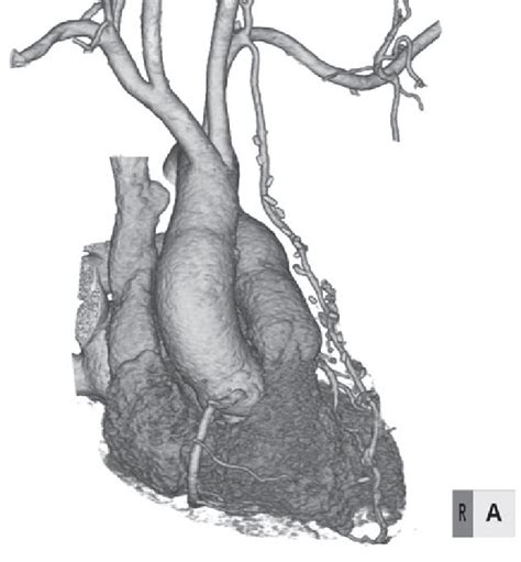 Enhanced Multi Detector Row Computed Tomography Performed 1 Week After Download Scientific