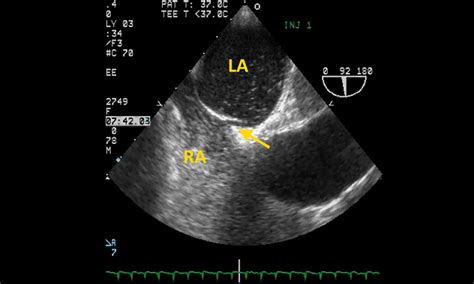 European Guidelines Represent First Intersocietal Position On Percutaneous Pfo Closure