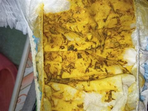 Itim Itim Sa Popo Ftm Po Bakit Po Kaya Ganito Poop Ni Lo 🥺