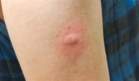 Flea Bites Vs Mosquito Bites Whats The Difference Lajaunies Pest