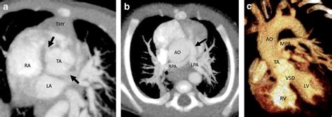 Truncus Arteriosus Types