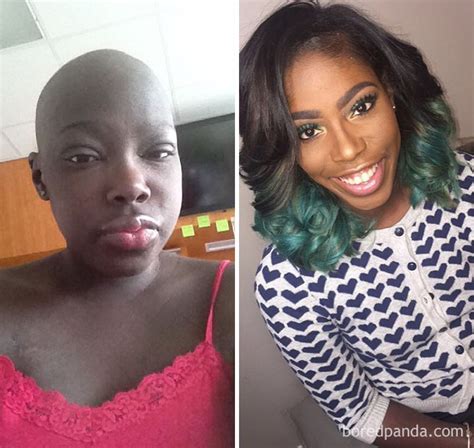 Chemotherapy Patient Before And After