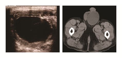 Strangulated Hernia Can Be A Risk Factor Of Seroma Following