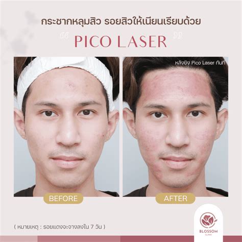 Pico Laser คืออะไร ทำไมถึงยอดนิยม ลดกระ ฝ้า ที่ Blossomclinic