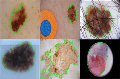 Some Example Images From The Isbi2017 Dataset For Skin Lesion