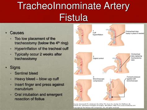 Ppt Chest Wall Lung Mediastinum And Pleura Powerpoint Presentation