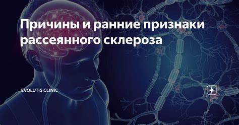 Причины и ранние признаки рассеянного склероза Evolutis Clinic Дзен