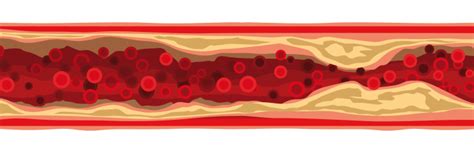 Was Bei Arteriosklerose Wirklich Hilft Raum And Zeit