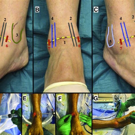 Arthroscopic Arthrodesis In A Right Ankle In A Patient With Severe