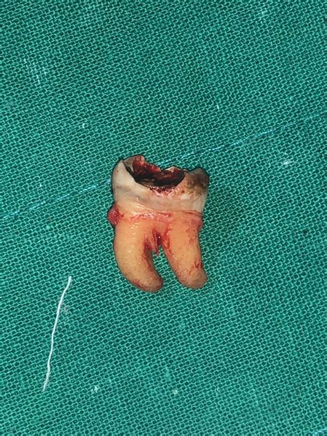 Wisdom Teeth Extraction Anil Dental