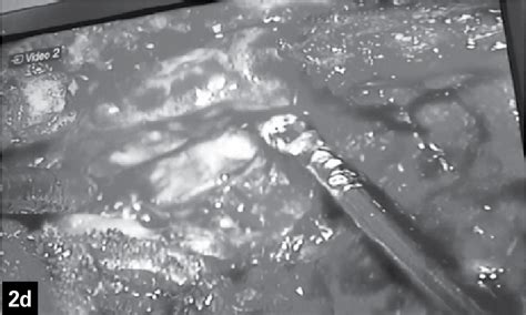 D Intraoperative View Showing An Sequestrated Disc Fragment With Download Scientific Diagram