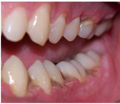 Mouth Ulcer Gingivitis At Marilyn Lewis Blog