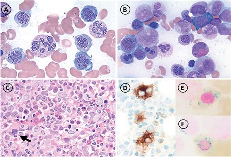 Megaloblastic Anemia Peripheral Smear Megaloblastic Anemia Peripheral Smear