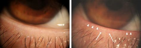 Evaluation Of Dry Eye And Meibomian Gland Dysfunction After Cataract