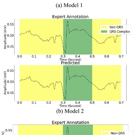 The Sample Plot Of Fetal Qrs Complex Classification Between Expert