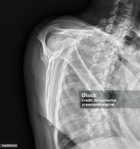 X선 어깨 관절 어깨 골절 진단을 위한 어깨 정면도 0명에 대한 스톡 사진 및 기타 이미지 0명 X 레이 건강 진단 Istock