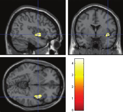 Statistical Parametric Maps Showing Regional Differences In Gm Volume