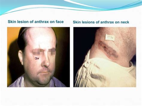 Anthrax Pptx