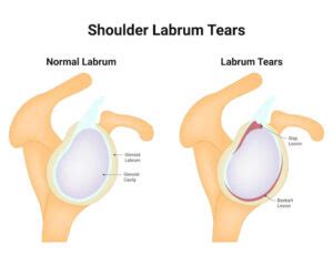 Bankart Tear Causes Symptoms And Treatment Options Dr Kritesh Mishra