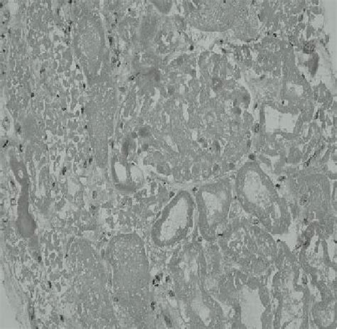Ghost Glomeruli Diffuse Cortical Necrosis H×e Download High Quality Scientific Diagram